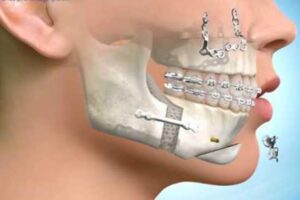 Jaw Chin Correction - GIA CLINICS
