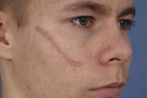 Scar Revision Surgery - GIA CLINICS